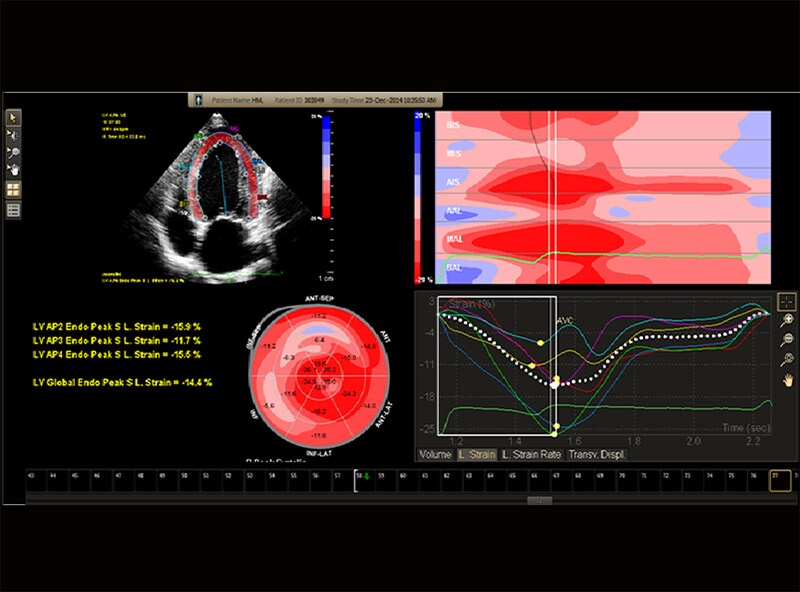It's high time for EPIQ | Philips Healthcare