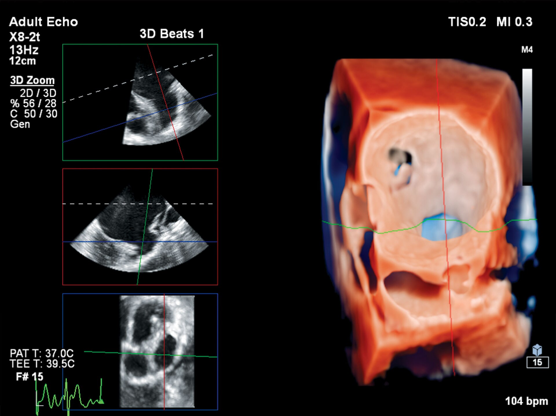 Sistemele de ecografie | Philips Healthcare